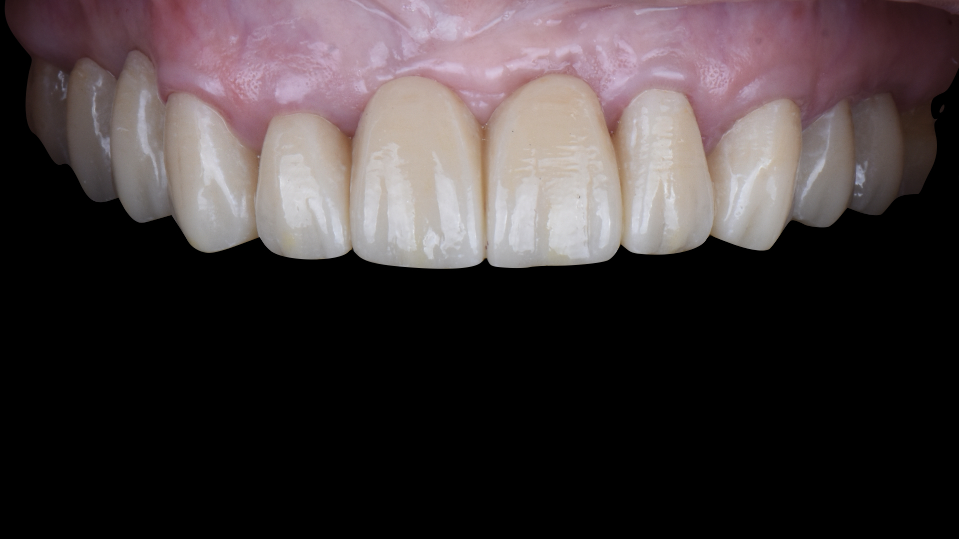 Restorative Dentistry – Costa Rica Dental Experience: Implants ...